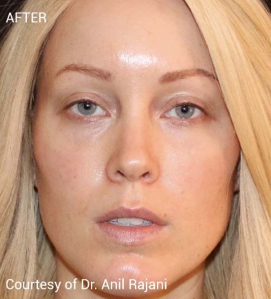 PRF Filler Before and After Photos | Sculpt MD Medspa