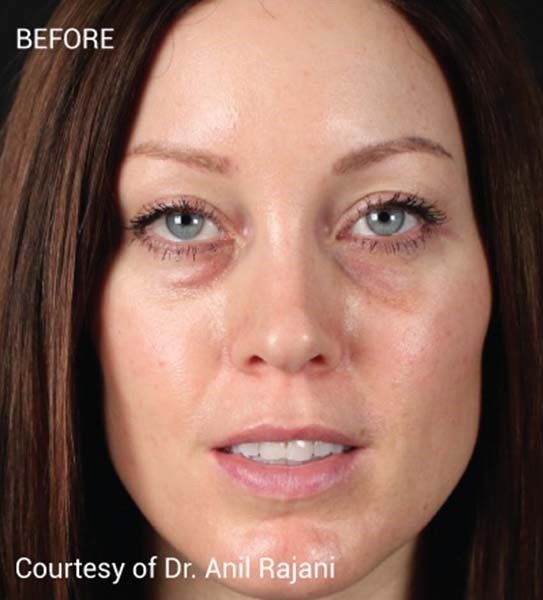 PRF Filler Before and After Photos | Sculpt MD Medspa