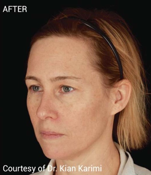 PRF Filler Before and After Photos | Sculpt MD Medspa