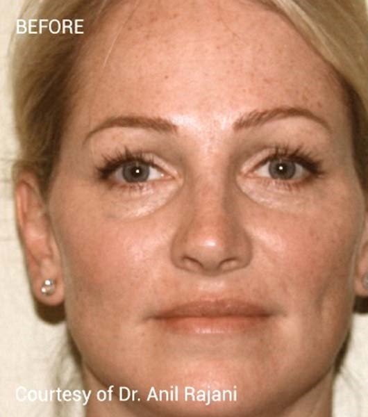 PRF Filler Before and After Photos | Sculpt MD Medspa