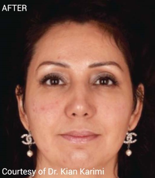 PRF Filler Before and After Photos | Sculpt MD Medspa