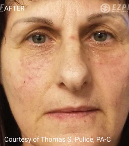 PRF Filler Before and After Photos | Sculpt MD Medspa