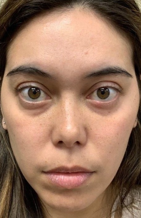 PRF Filler Before and After Photos | Sculpt MD Medspa