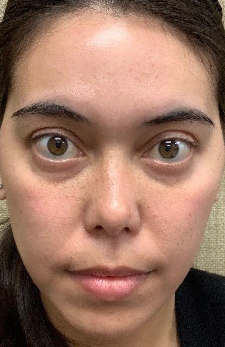 PRF Filler Before and After Photos | Sculpt MD Medspa