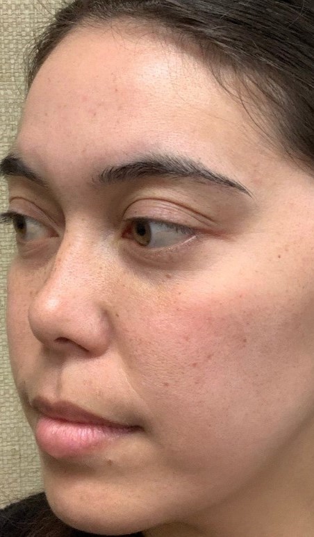 PRF Filler - Sculpt MD