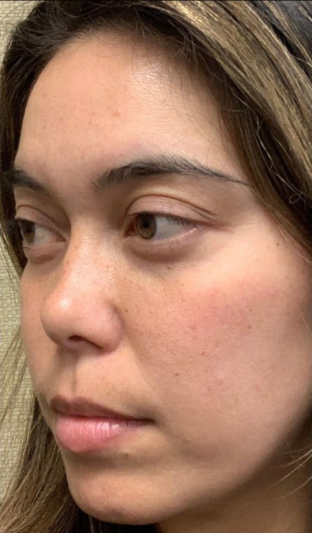 PRF Filler - Sculpt MD