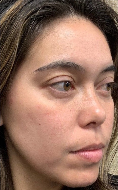 PRF Filler - Sculpt MD