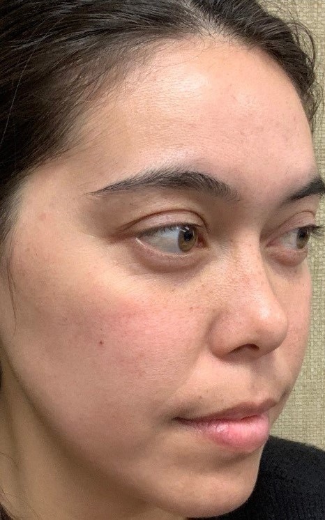 PRF Filler - Sculpt MD