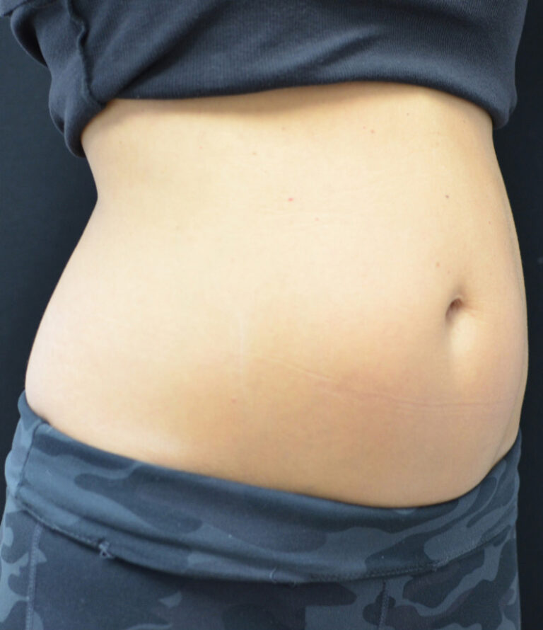 Abdomen - Sculpt MD