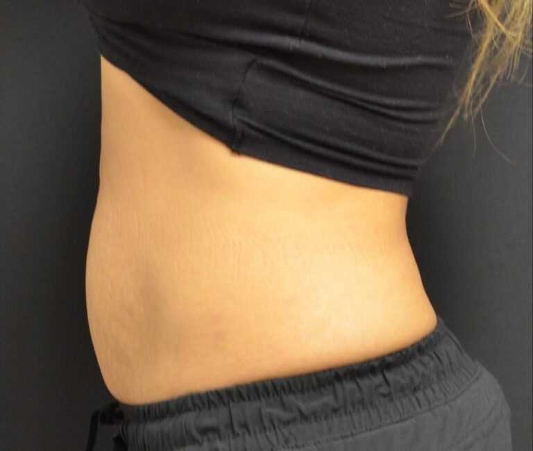 Emsculpt NEO Before and After Abdomen | Sculpt MD Medspa