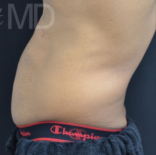 Abdomen - Sculpt MD