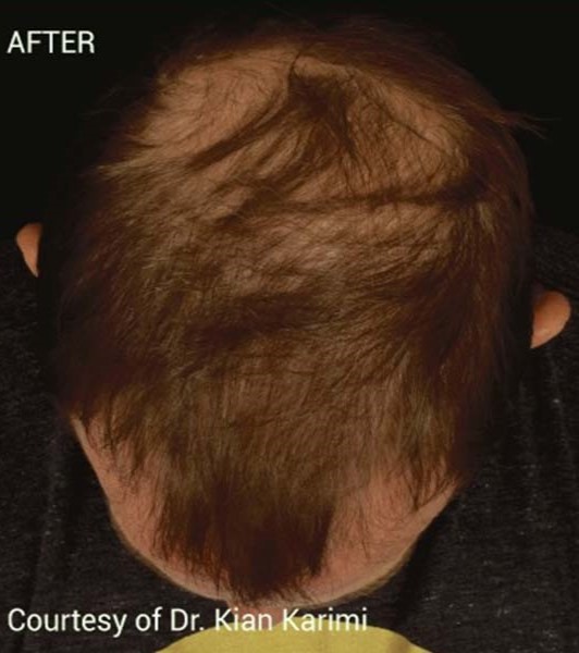 PRF Hair Restoration Before and After | Sculpt MD Medspa