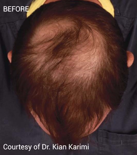 PRF Hair Restoration Before and After | Sculpt MD Medspa