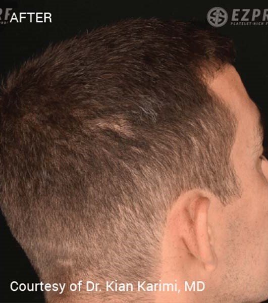 PRF Hair Restoration Before and After Image Gallery - Sculpt MD