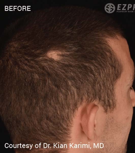 PRF Hair Restoration Before and After Image Gallery - Sculpt MD