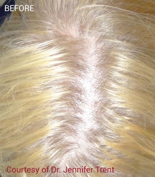 PRF Hair Restoration Before and After Image Gallery - Sculpt MD